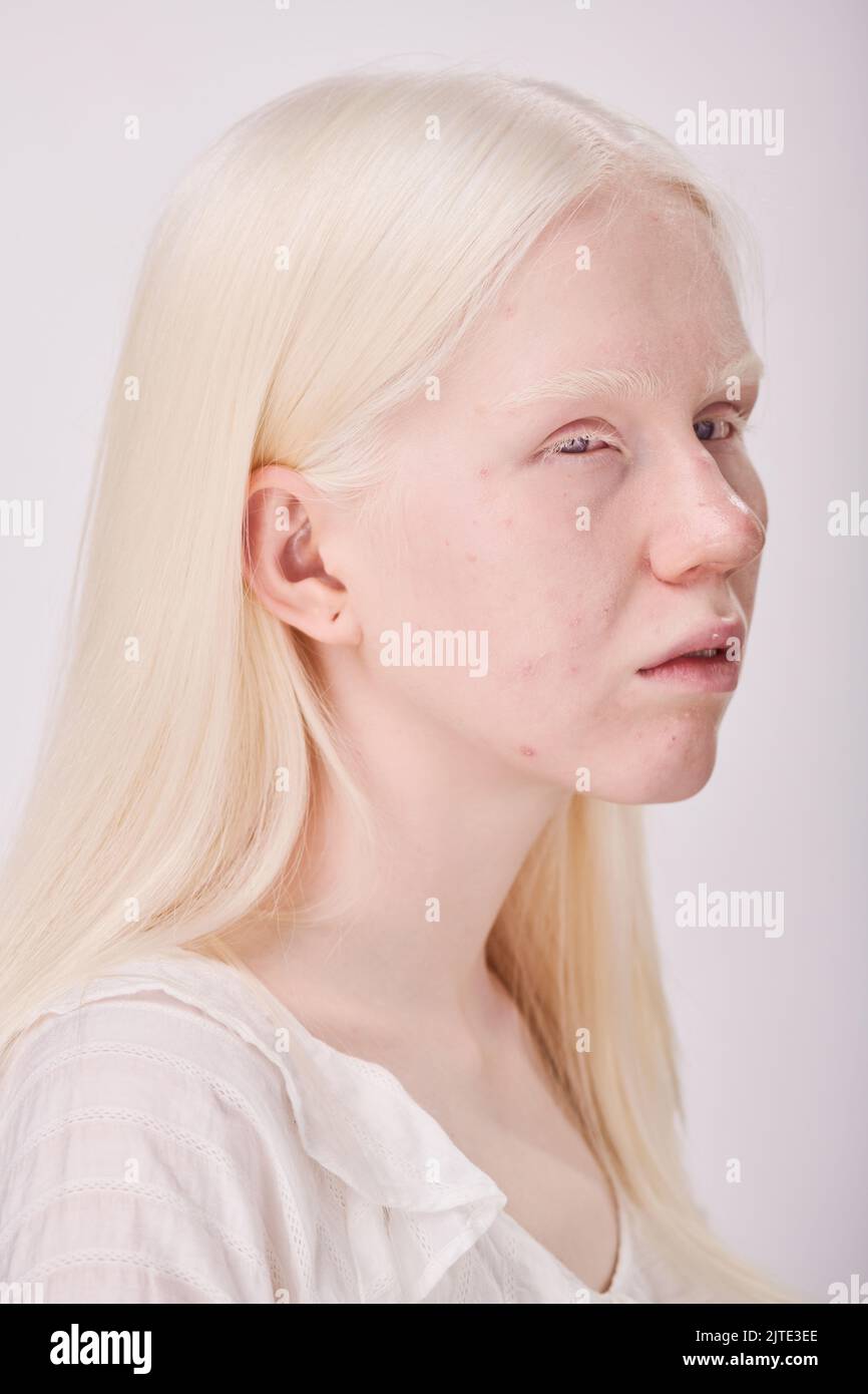 Portrait of young albino woman with unusual appearance isolated on ...