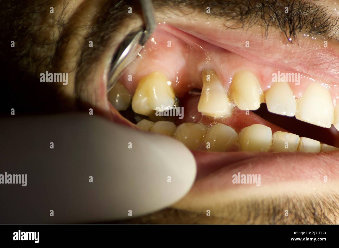 Prosthetics teeth hi-res stock photography and images - Alamy