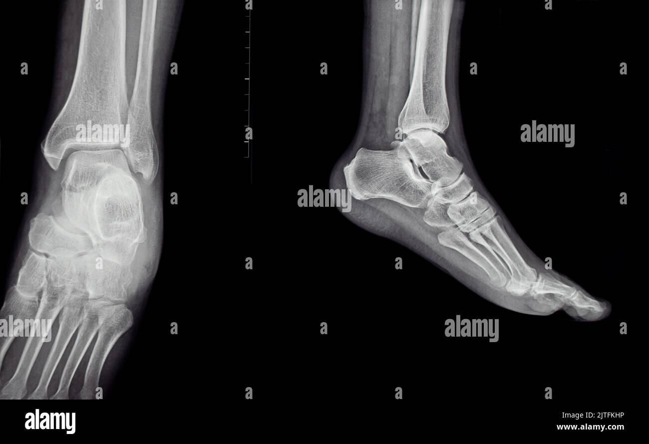 X-rays of the human foot from two angles, examination Stock Photo - Alamy