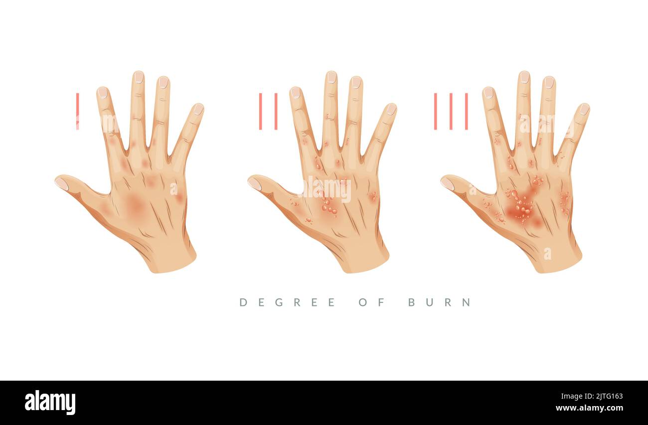 Second degree burn hi-res stock photography and images - Alamy