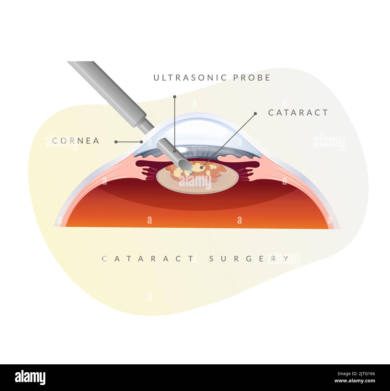 Human Eye - Cataract Procedure - Illustration as EPS 10 File Stock ...