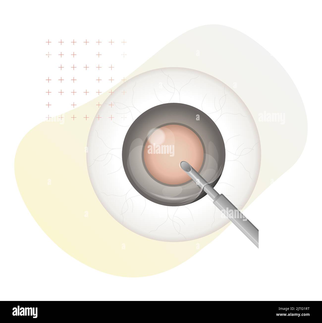 Human Eye - Cataract Procedure - Illustration as EPS 10 File Stock ...