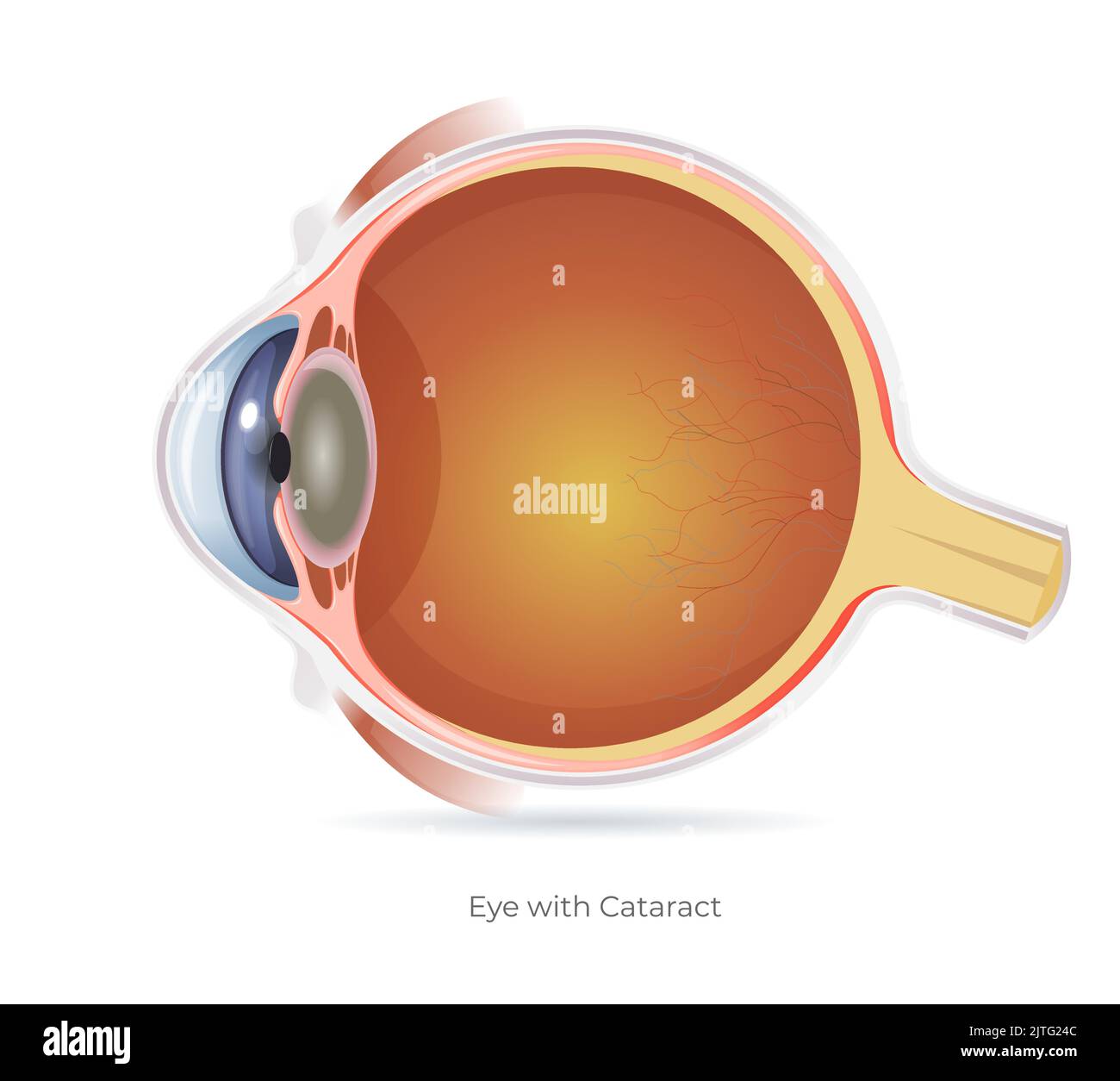 Human Eye with Cataract - Illustration as EPS 10 File Stock Vector ...