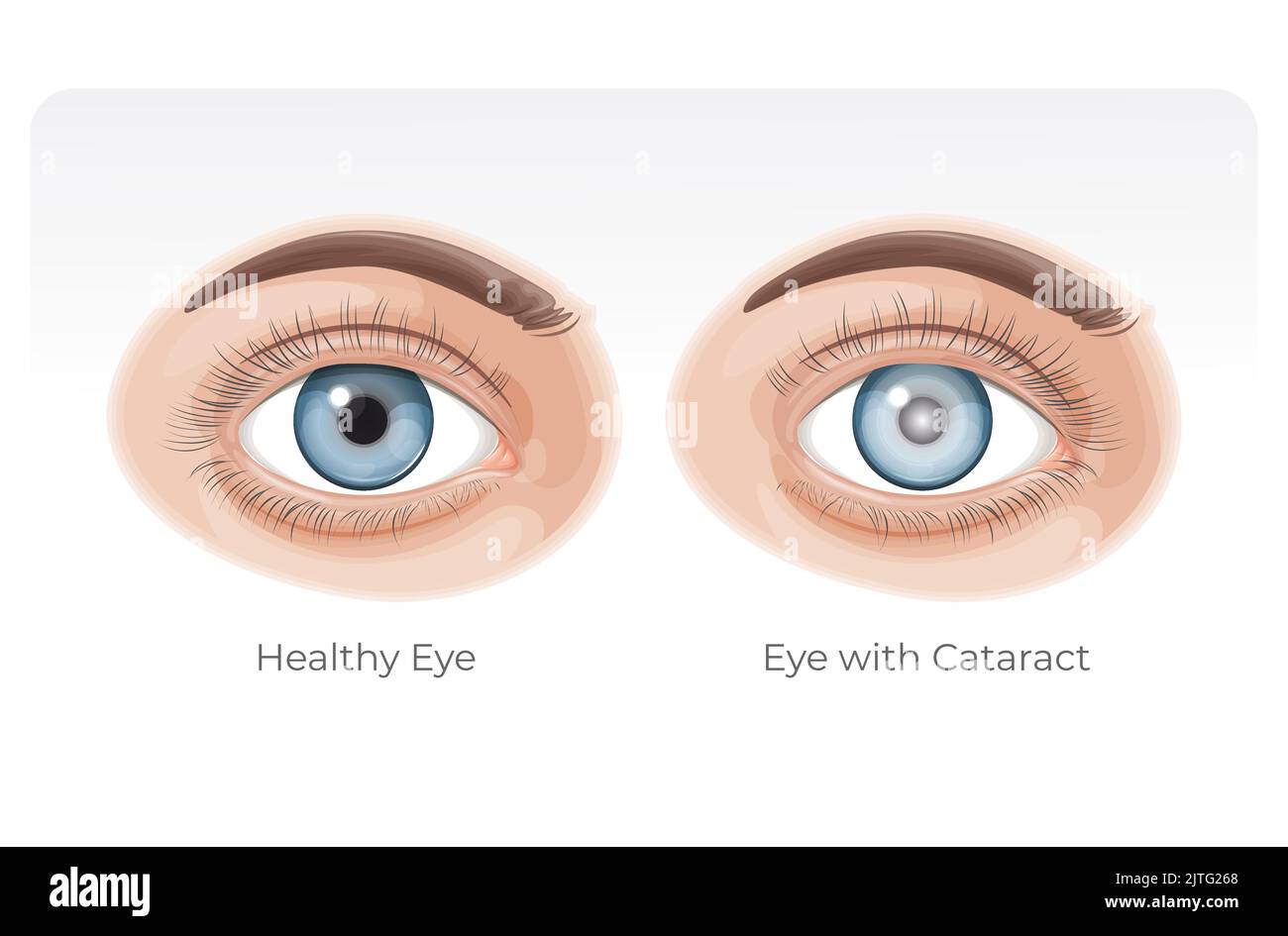 Human Healthy Eye and Eye with Cataract - Illustration as EPS 10 File ...