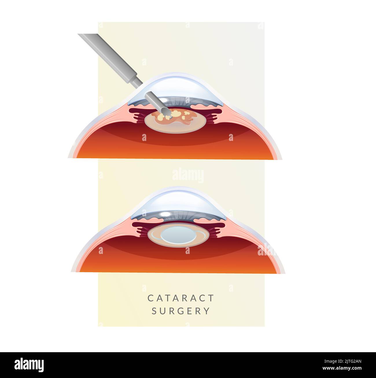 Cataract vector vectors Stock Vector Images - Alamy