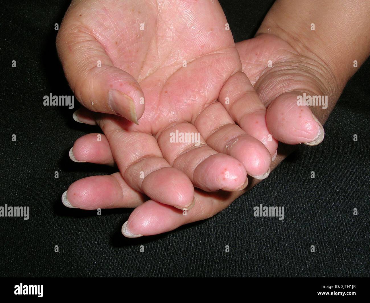Palmar plantar psoriasis Stock Photo - Alamy
