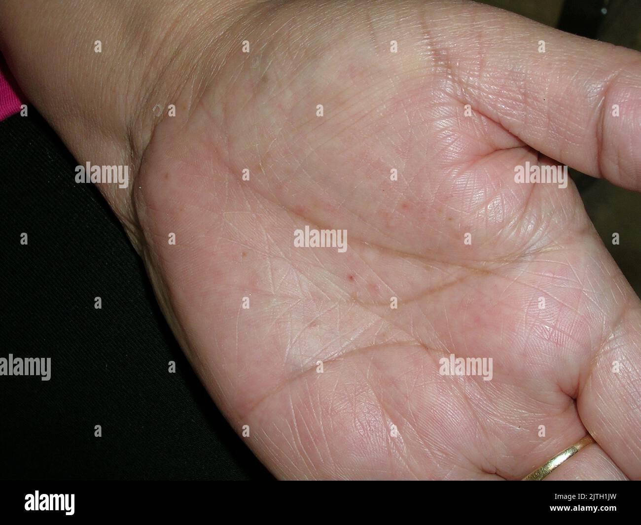 Palmar plantar psoriasis Stock Photo - Alamy