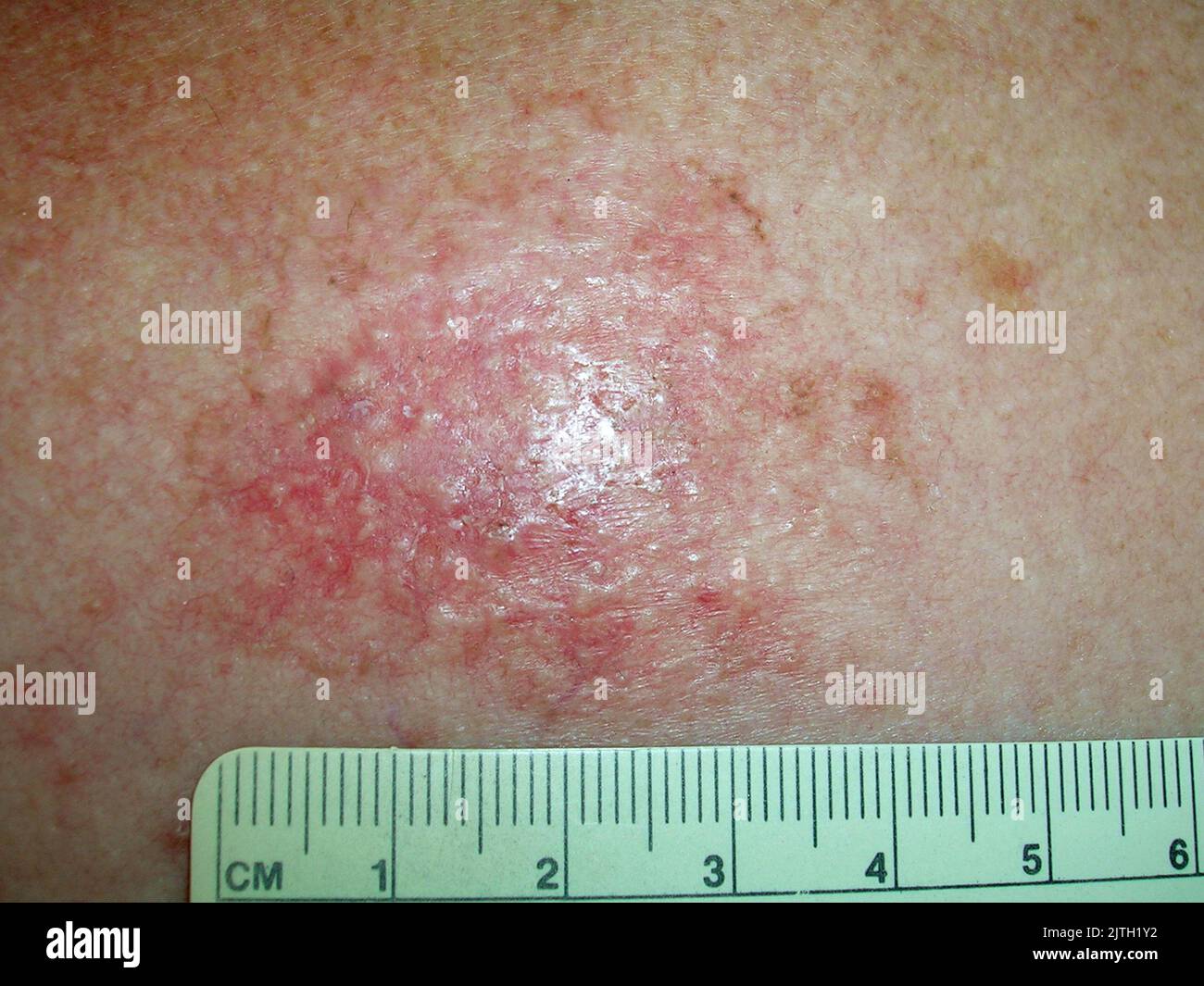 Superficial basal cell carcinoma Stock Photo - Alamy