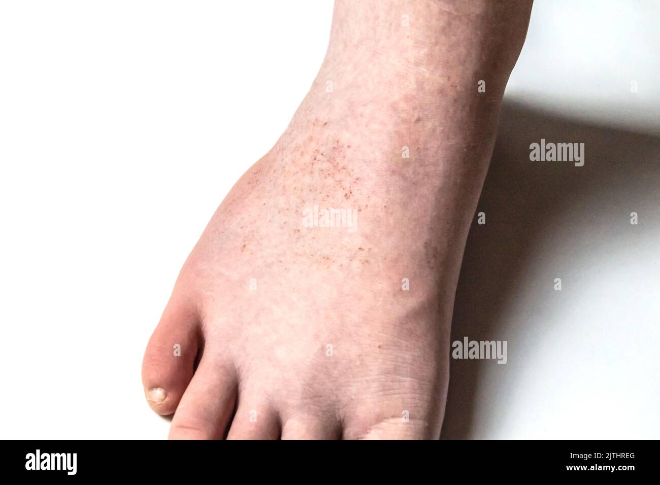 Skin with allergy, food allergy, dermatitis, insect bites, irritation ...