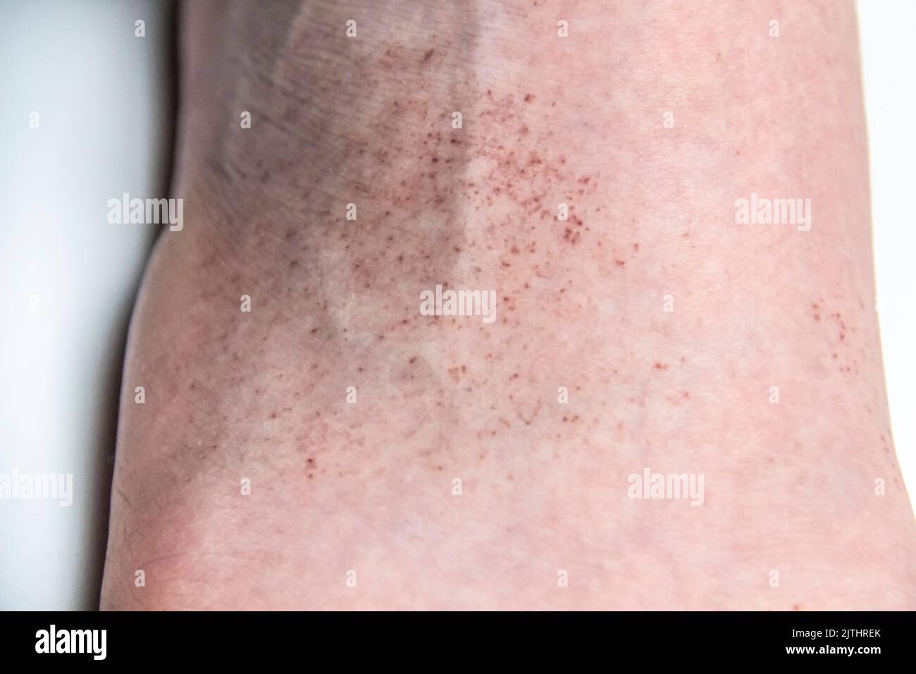 A red rash on the foot of a male against background. CloseUp a part of ...