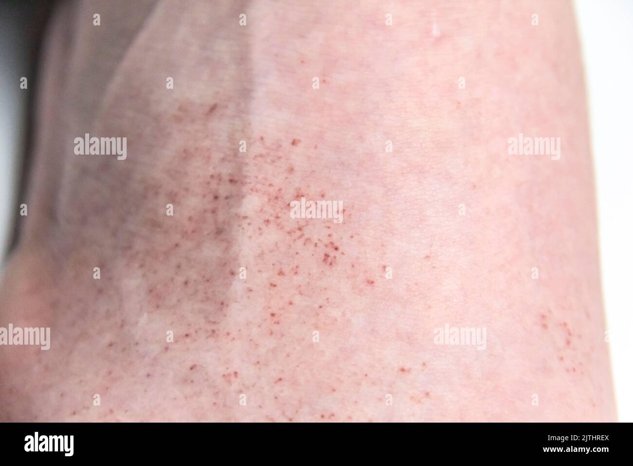 A red rash on the foot of a male against background. CloseUp a part of ...