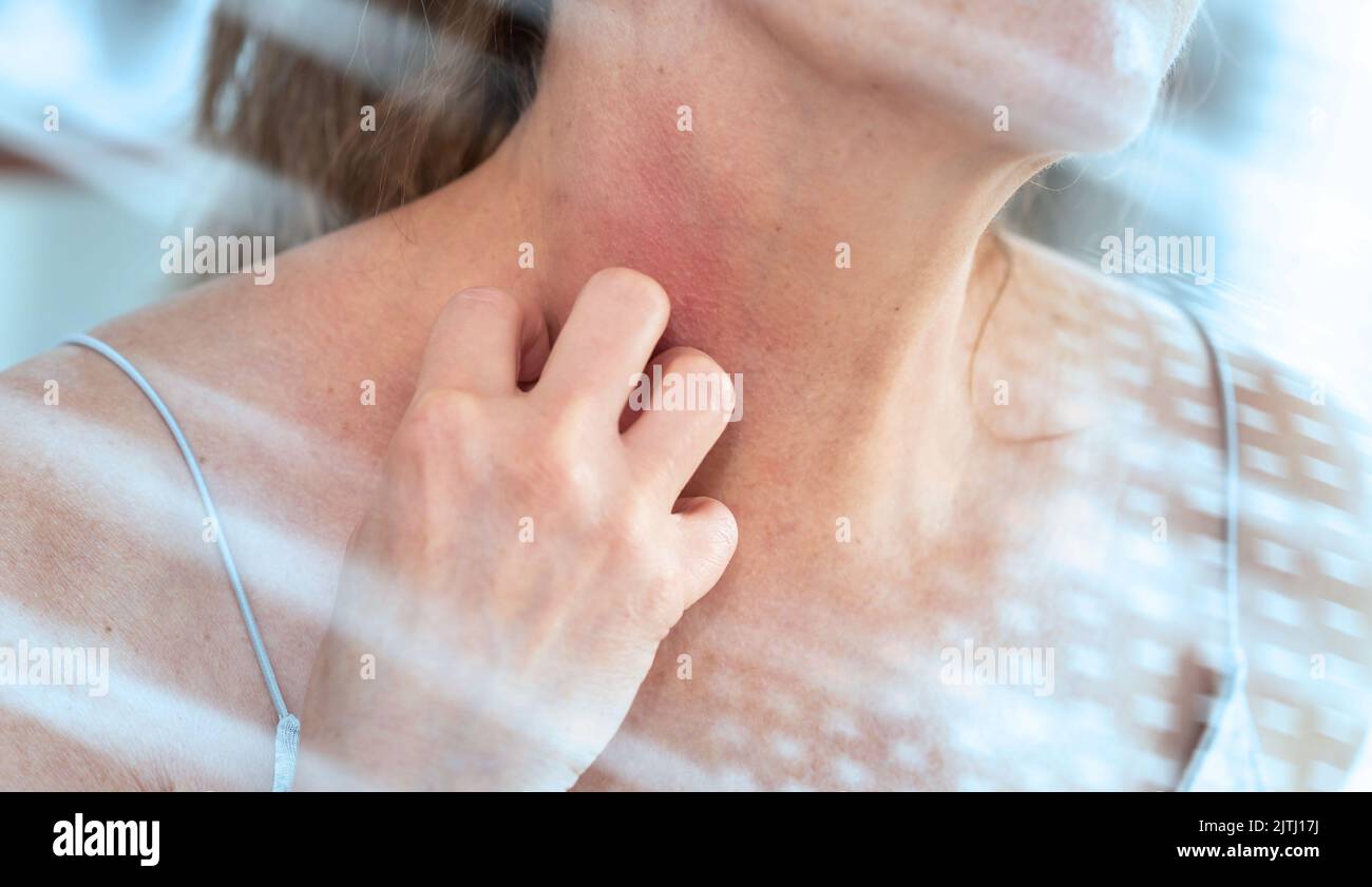 Woman having itchy and scratching her neck. allergy symptoms; light ...