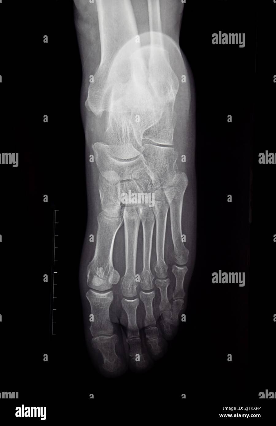 an x-ray of the sole of the human foot, medical, bones Stock Photo - Alamy