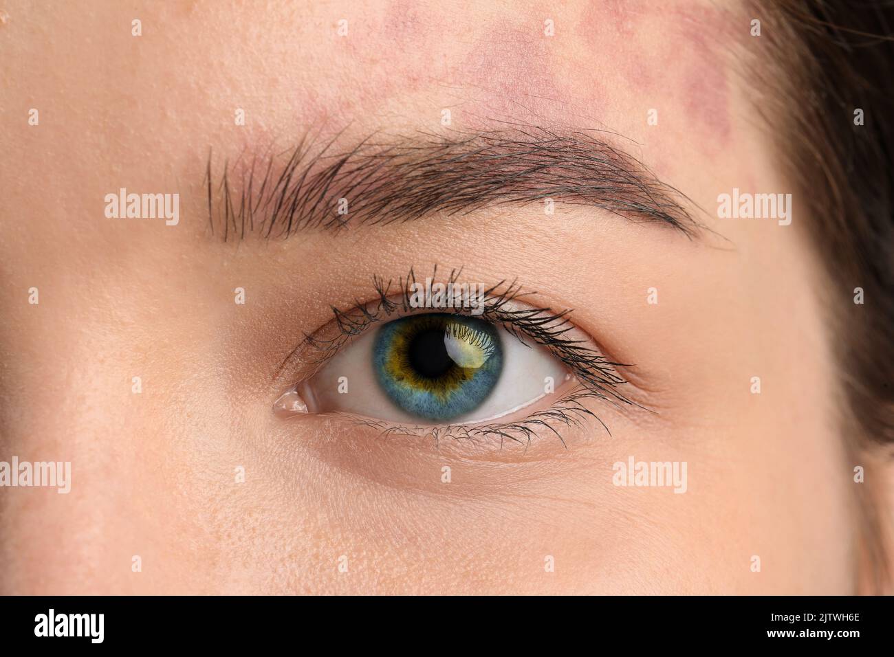 Eterocromia Iridis Heterocromía Iridis: Ojos De Cada Color. ¿Qué