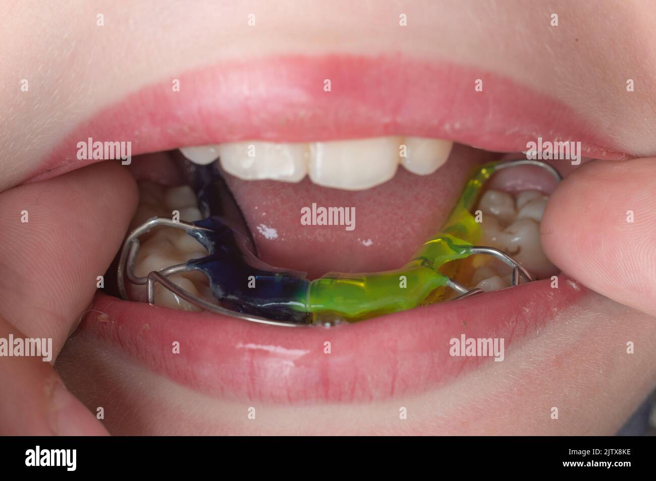 Mandibular plate, boy wearing teeth aligner, teeth and plate in detail ...
