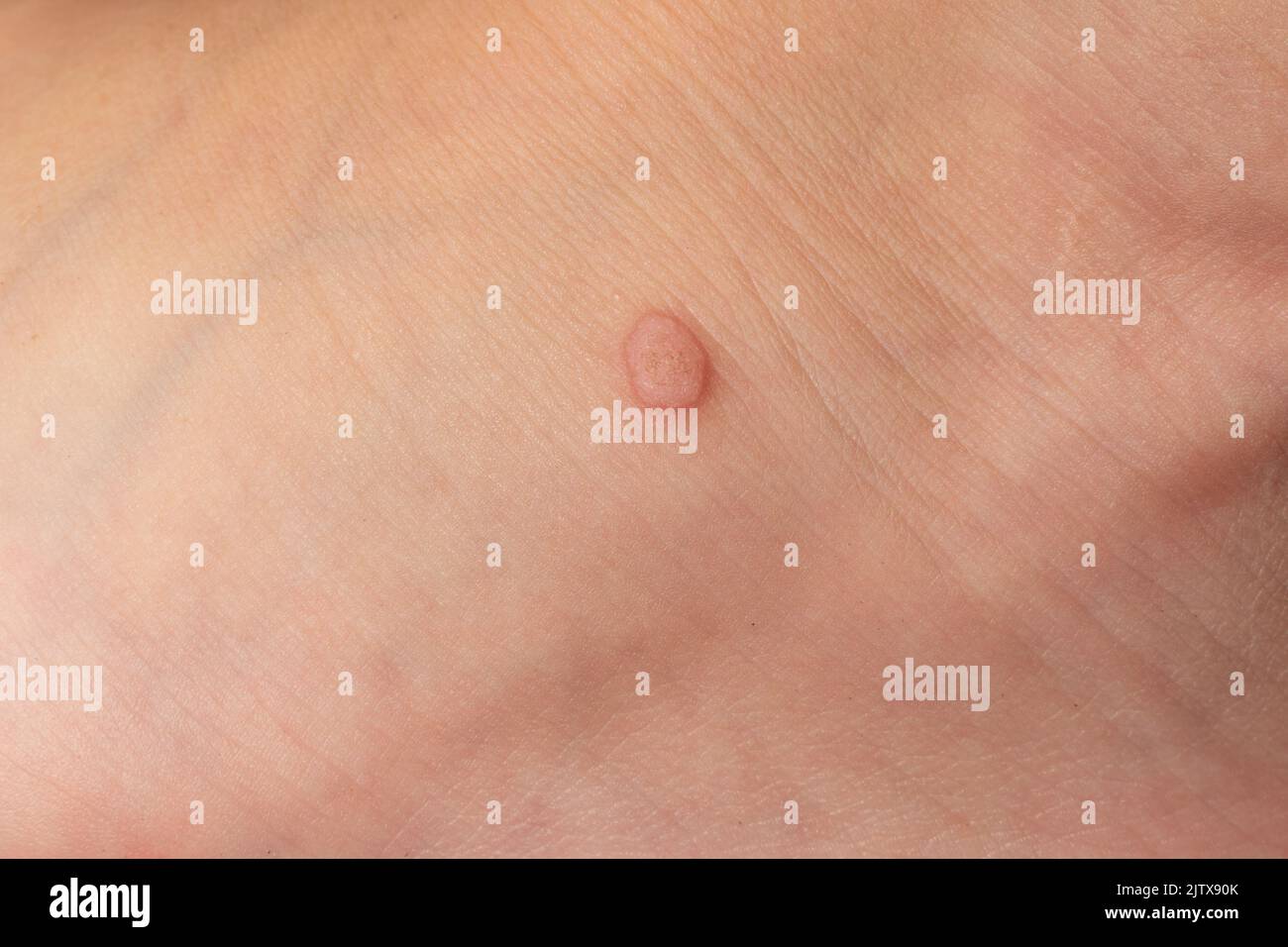 Common wart Verruca vulgaris on the skin of a child, papillomavirus in ...
