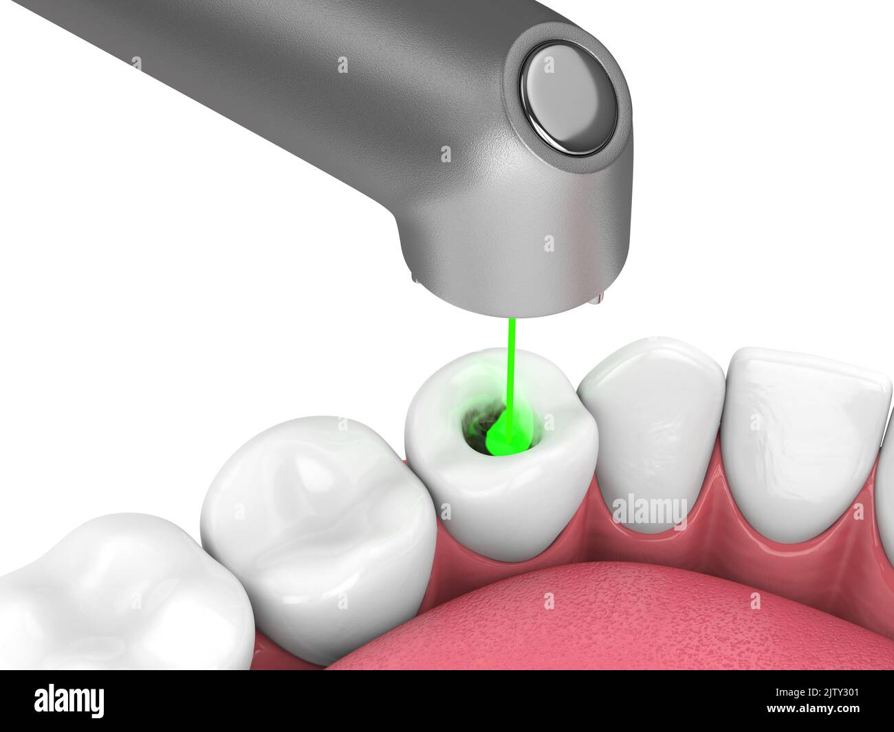 3d render of removing tooth decay with dental laser. Painless tooth ...