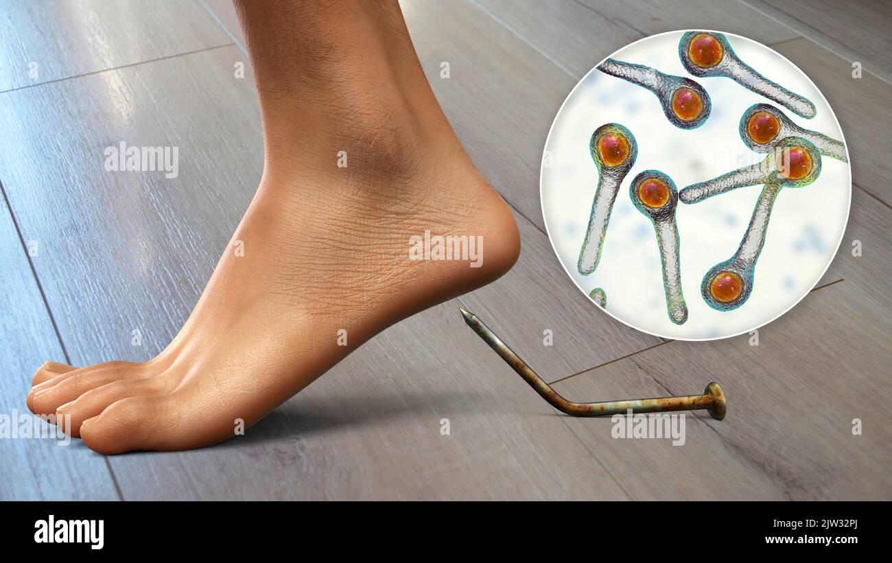 Bacterial infection wound hi-res stock photography and images - Alamy