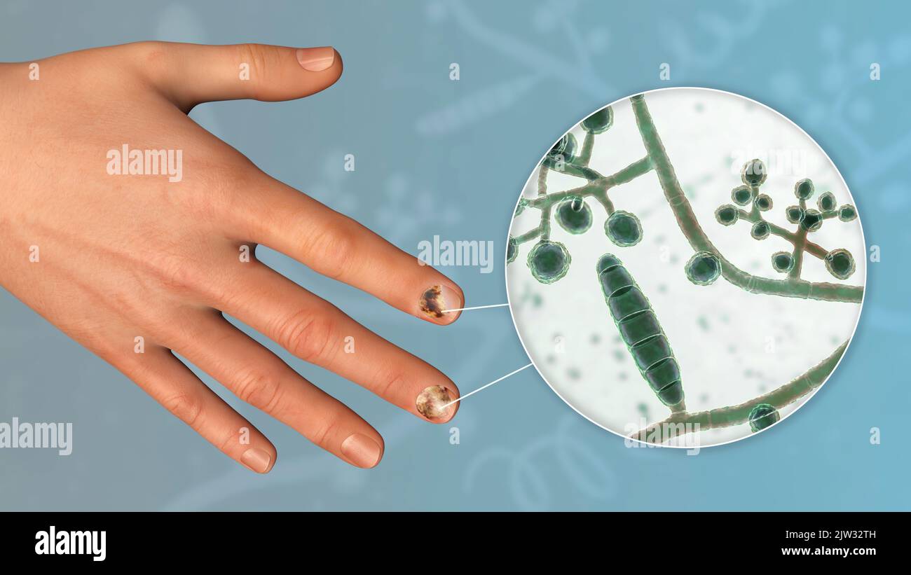 Illustration of a fungal nail infection showing a human hand with ...