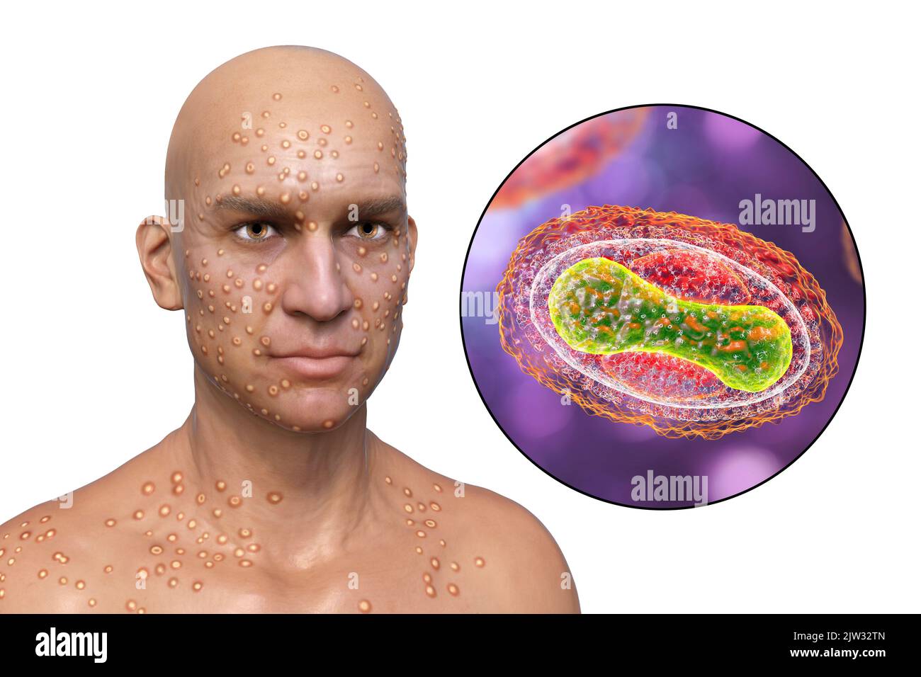 Bovine papular stomatitis virus hi-res stock photography and images - Alamy