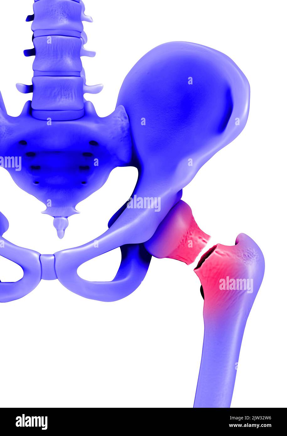 Illustration showing a fracture in the neck of the femur (thigh bone ...