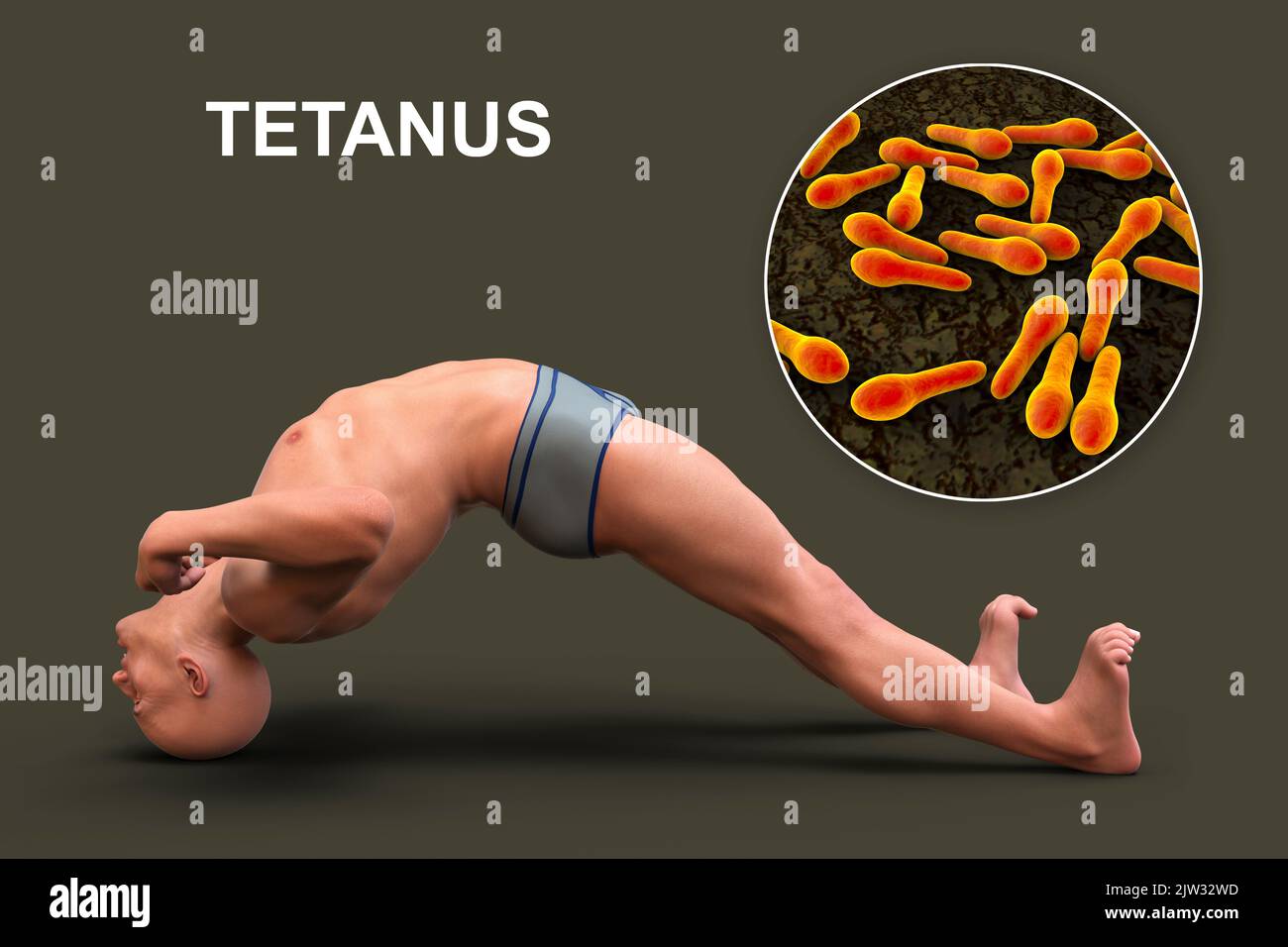 Illustration of opisthotonus (backward spasm) in a man with tetanus. Opisthotonus is a state of ...