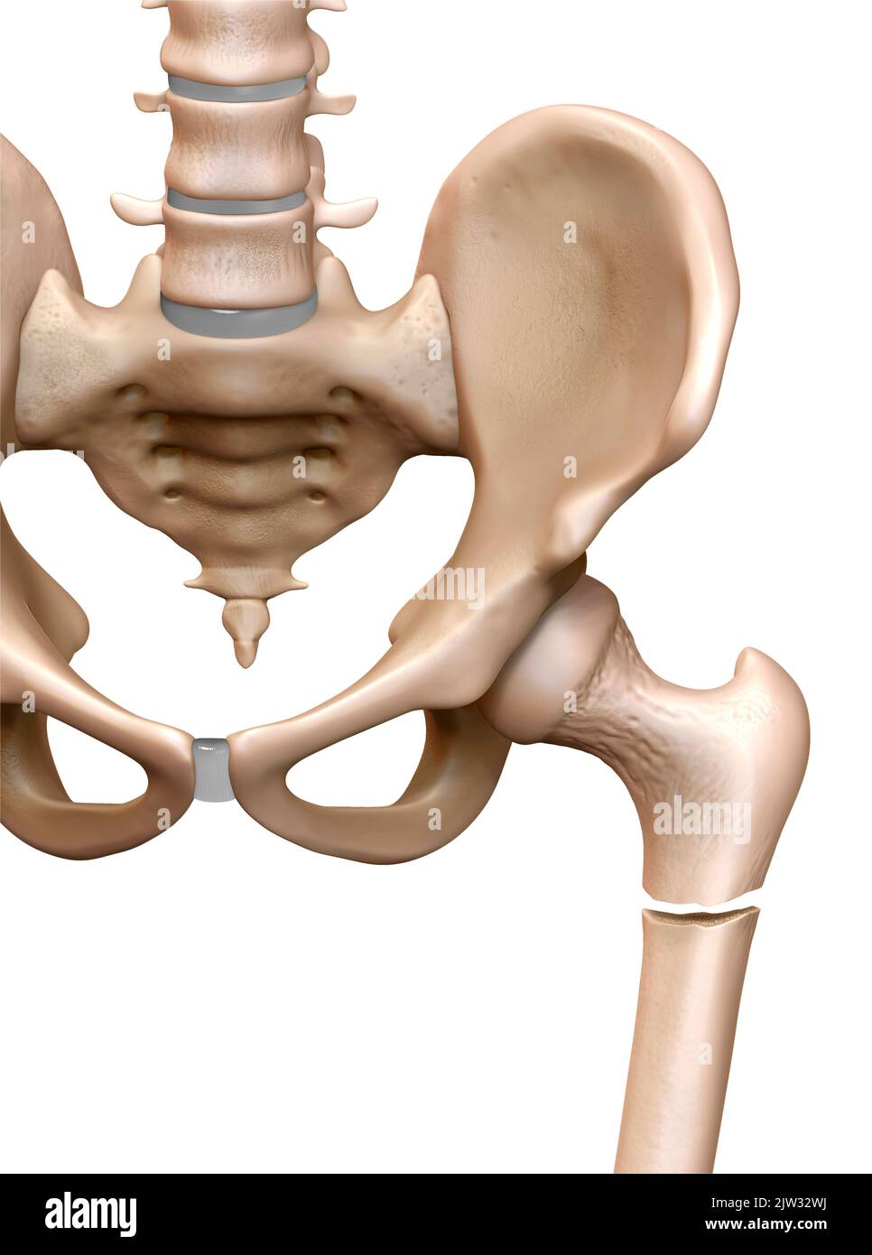 Illustration showing a fracture in the neck of the femur (thigh bone ...