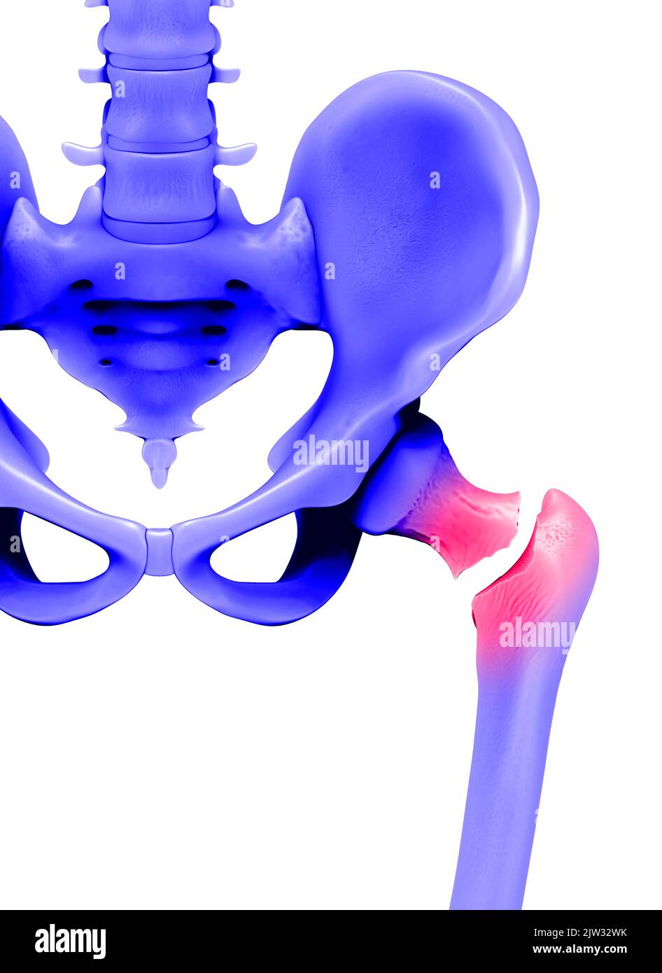 Femure fracture hi-res stock photography and images - Alamy