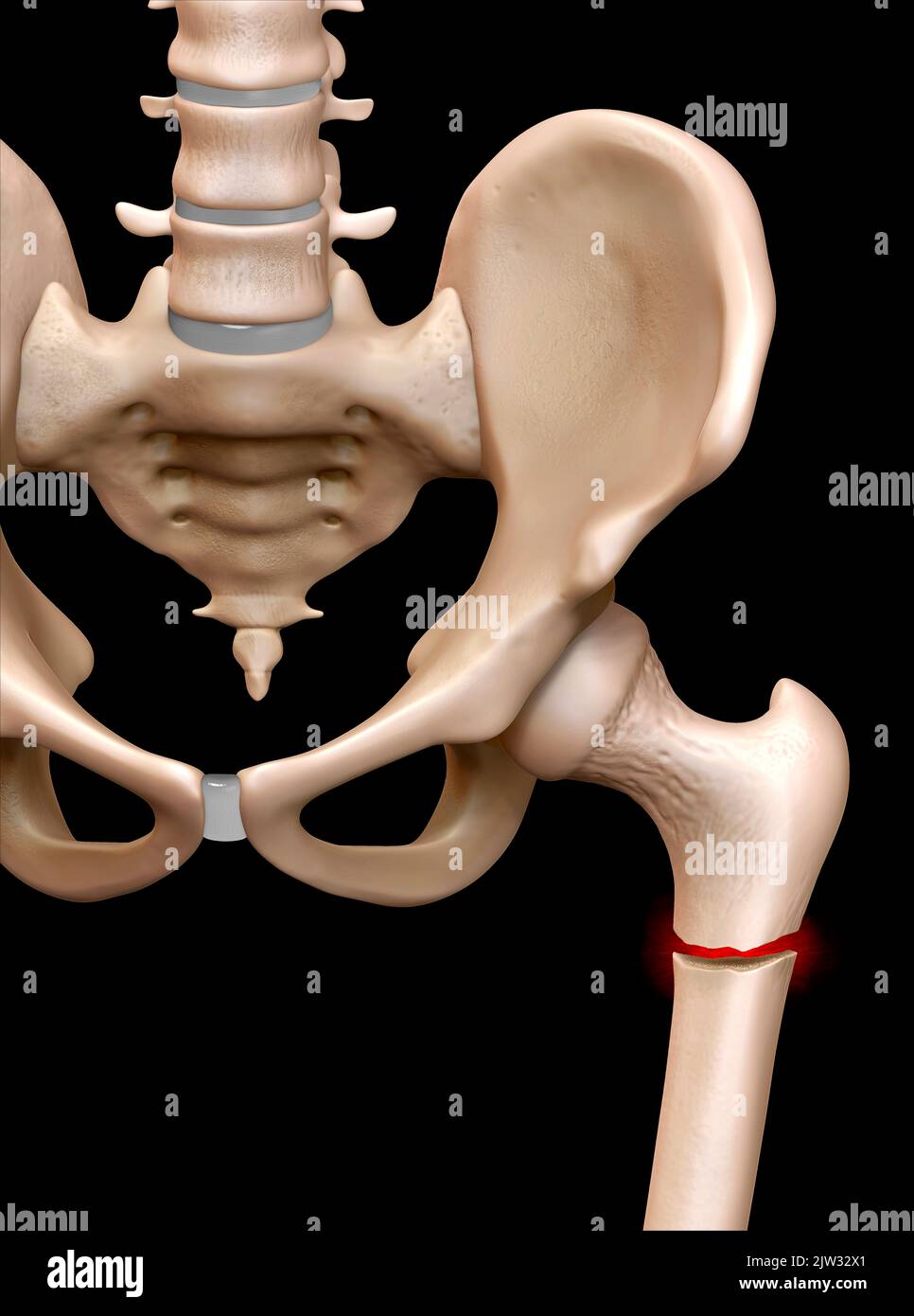 Illustration showing a fracture in the neck of the femur (thigh bone ...