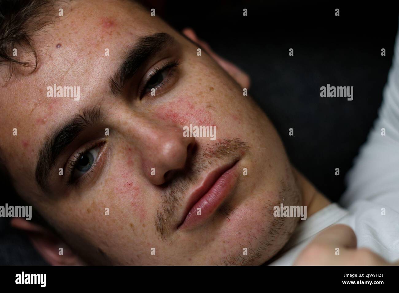 Young man people virus. Monkeypox new disease dangerous over the world ...