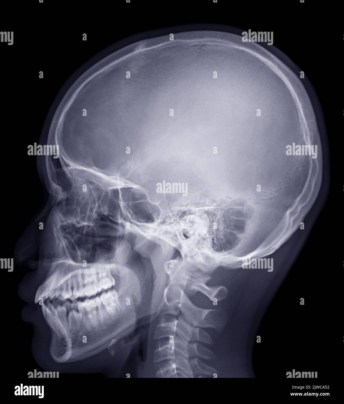 Skull x-ray image of Human name is skull lateral view isolated on Black ...