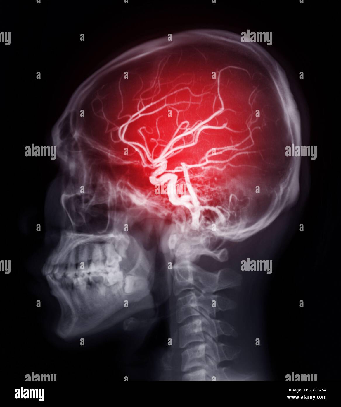 Skull image fusion with MRI MRA Brain for evaluate them stenosis and ...