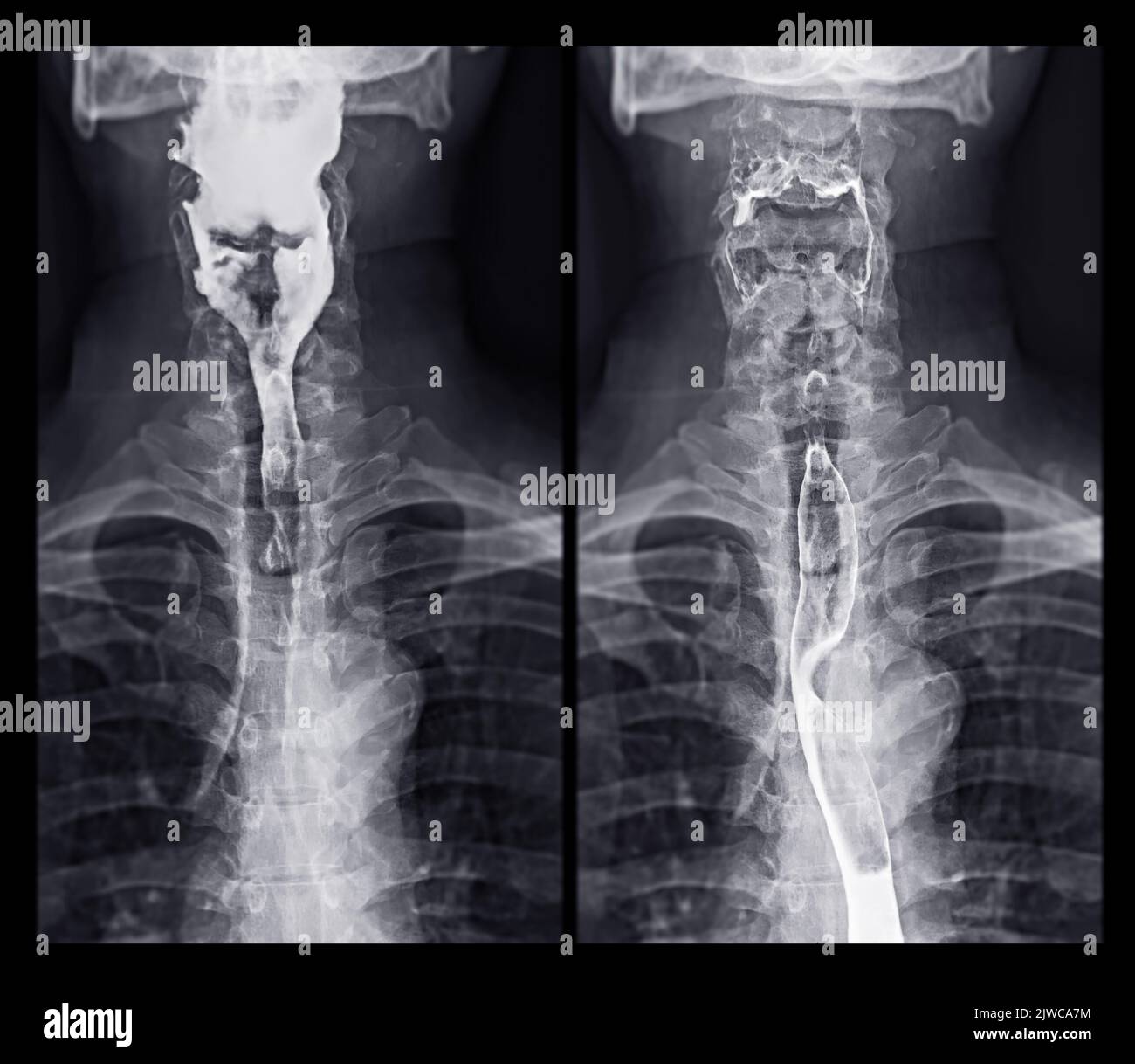 Barium Swallow study test diagnose Barrett's GI tract exam GERD ulcers ...