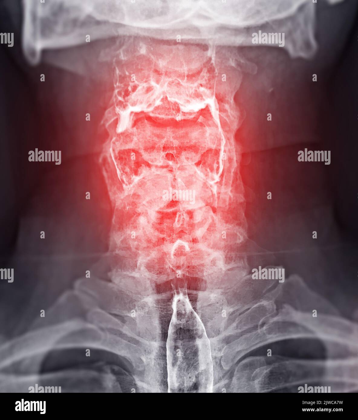 Barium Swallow study test diagnose Barrett's GI tract exam GERD ulcers ...