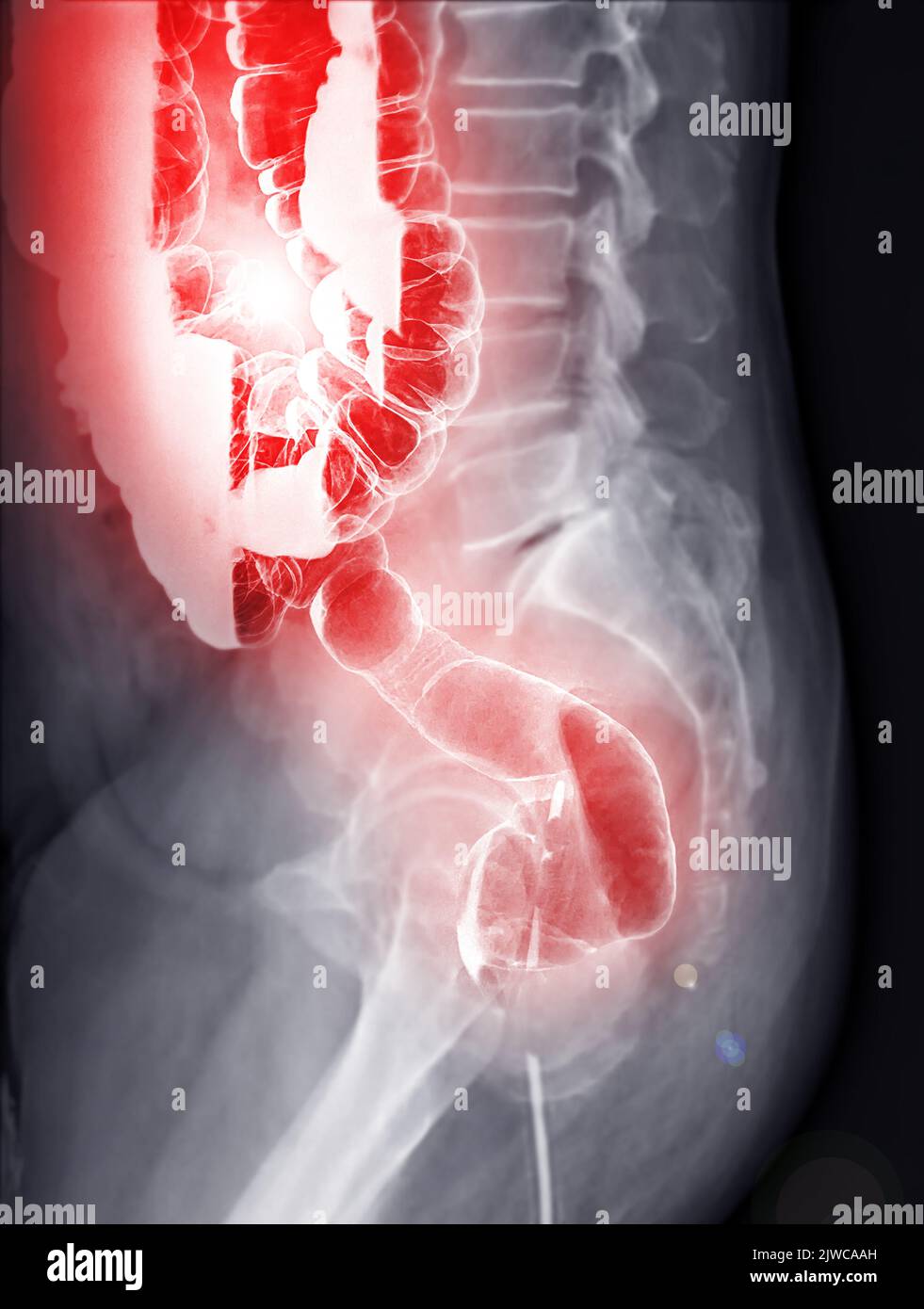 Barium enema or BE is image of large bowel after injection of barium ...
