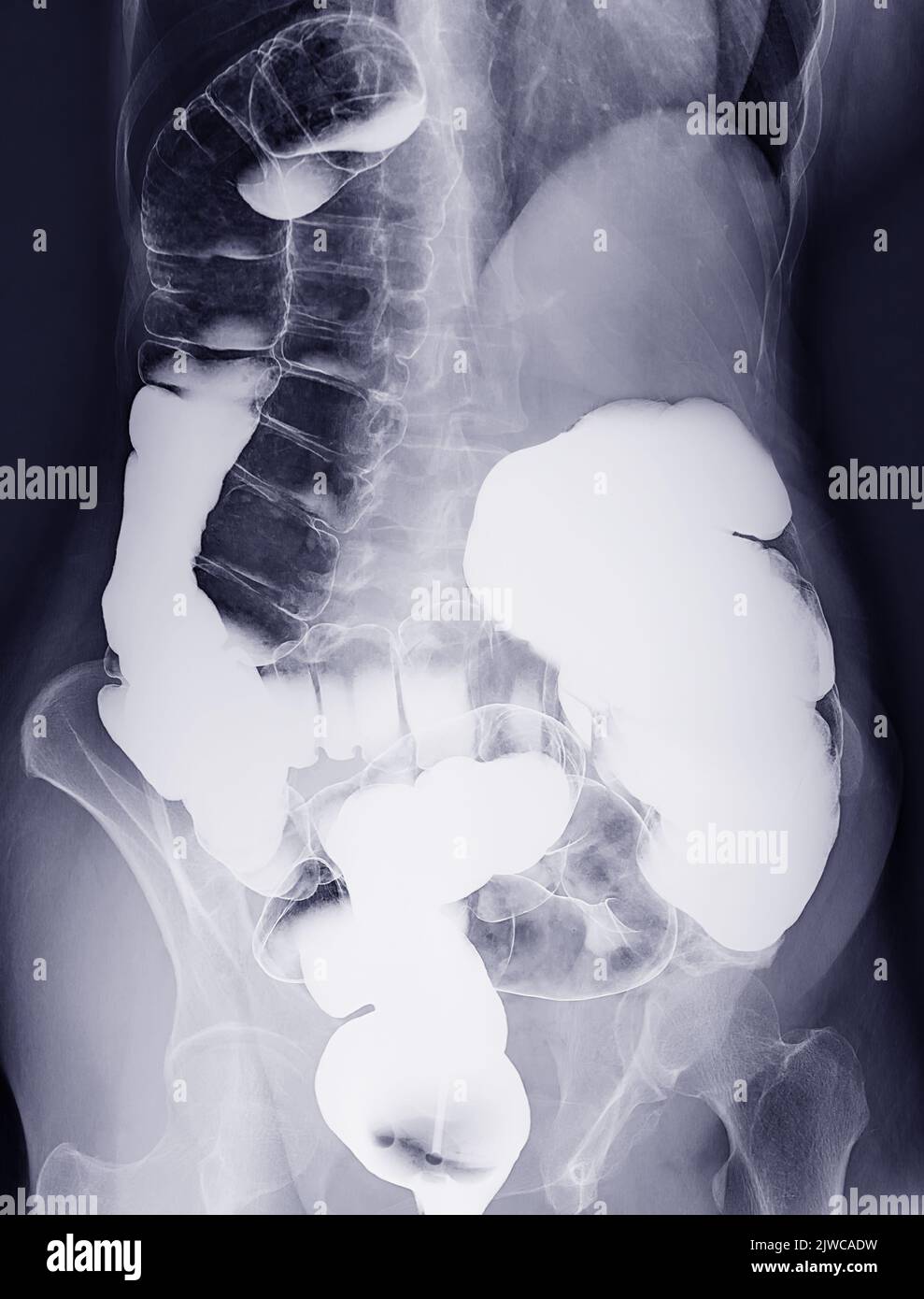 Barium enema or BE is image of large bowel after injection of barium ...