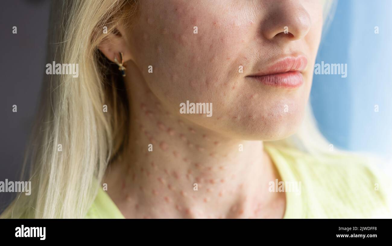 Papules after beauty injections on the face. Closeup photo Stock Photo ...