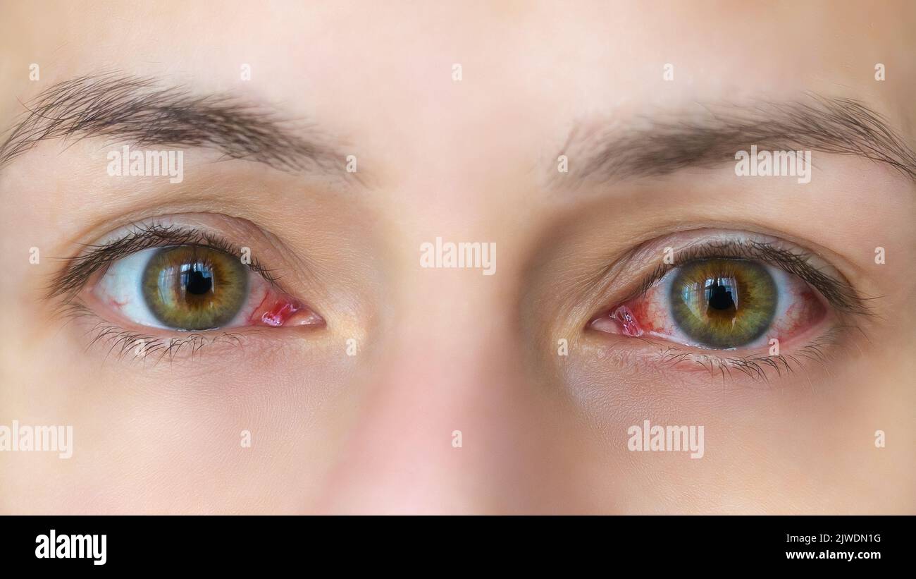 Sore red eyes woman hi-res stock photography and images - Alamy