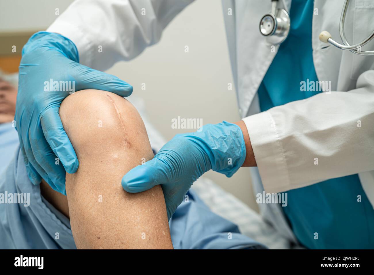 Asian senior or elderly old lady woman patient show her scars surgical ...