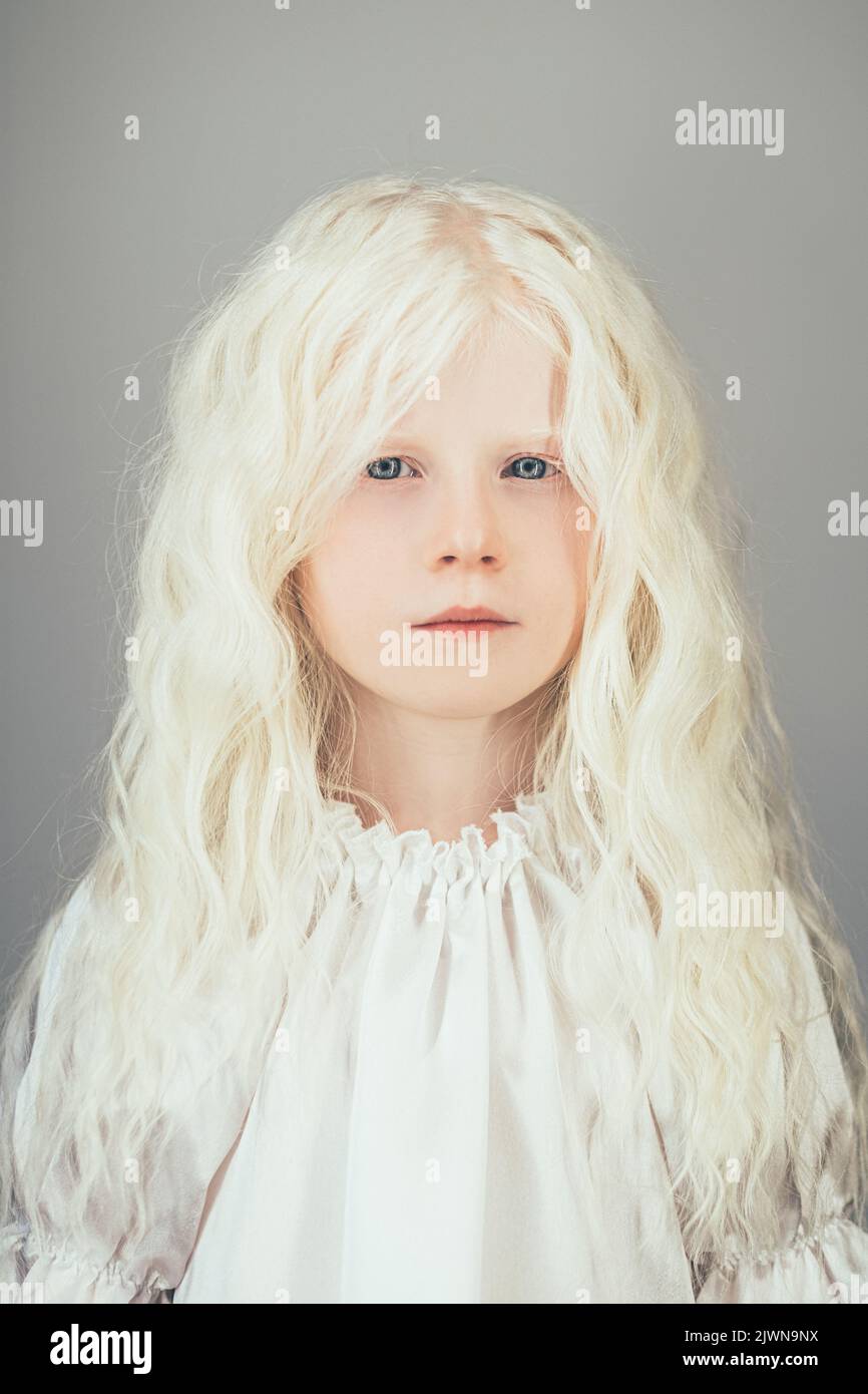 Caucasian Albino Woman