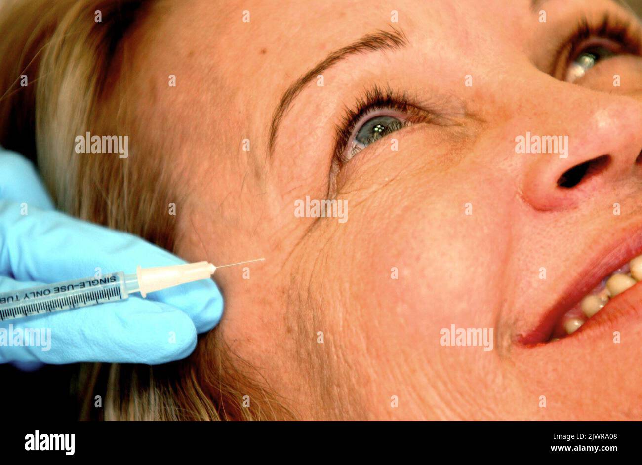 PA PHOTOS/AAP - UK USE ONLY : A patient receiving an injection of Botox ...