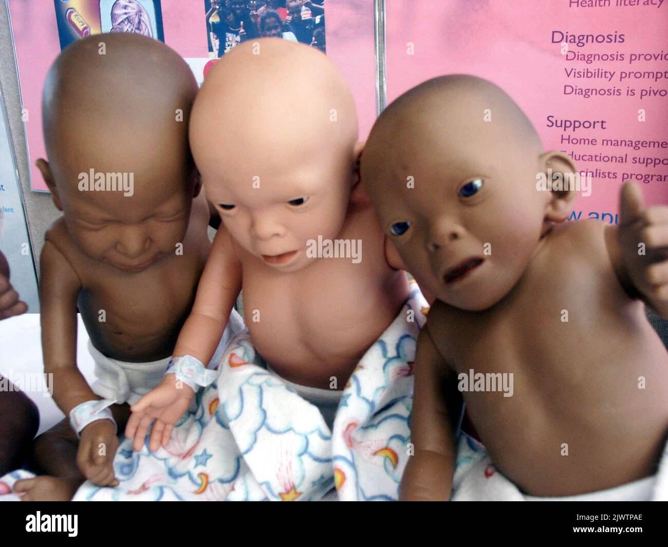 These dolls are designed to portray the affects of Foetal Alcohol ...