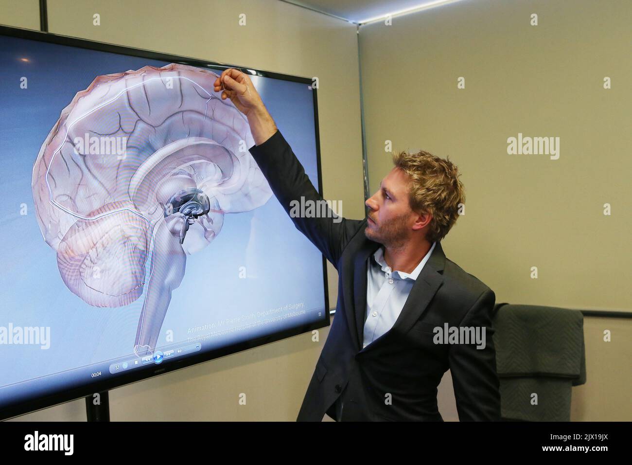 Dr Nicholas Opie demonstrates where stent-based electrode would be ...