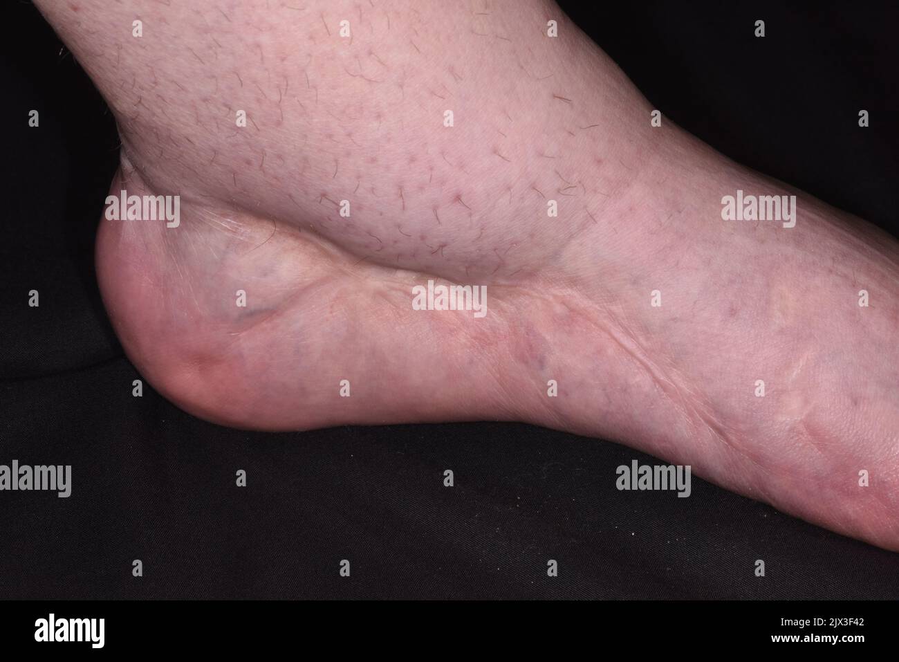 Distortion of the foot of a 24 year old female patient following ...