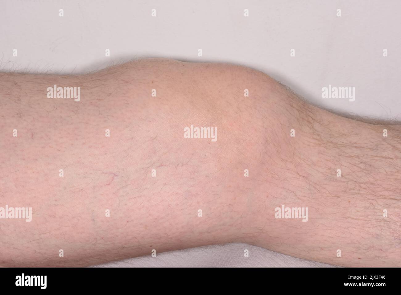 Swollen knee of a 52 year old male patient following a twisting injury ...