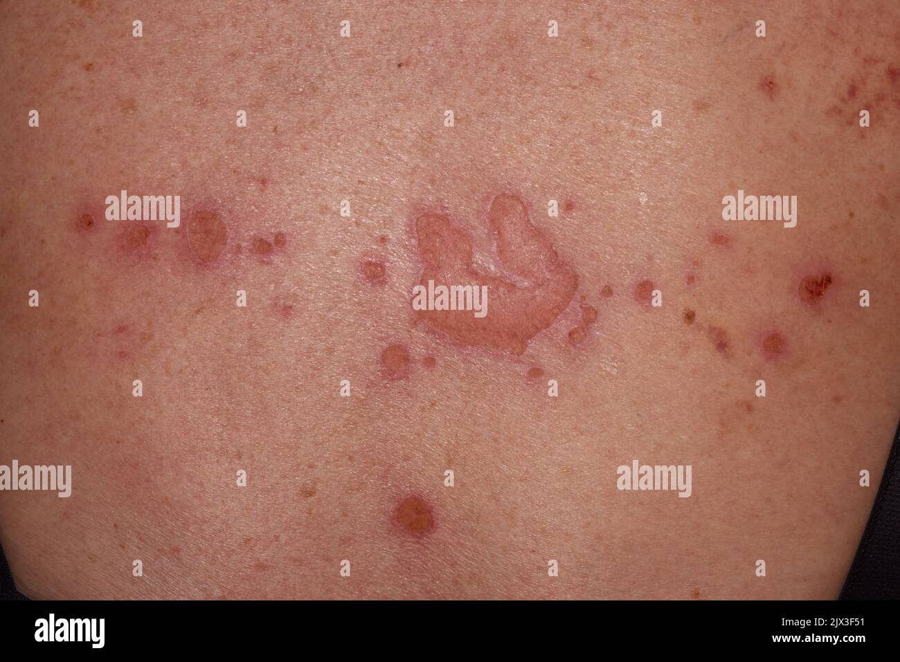 Chlorine burn on the back of a 54 year old female patient after using ...