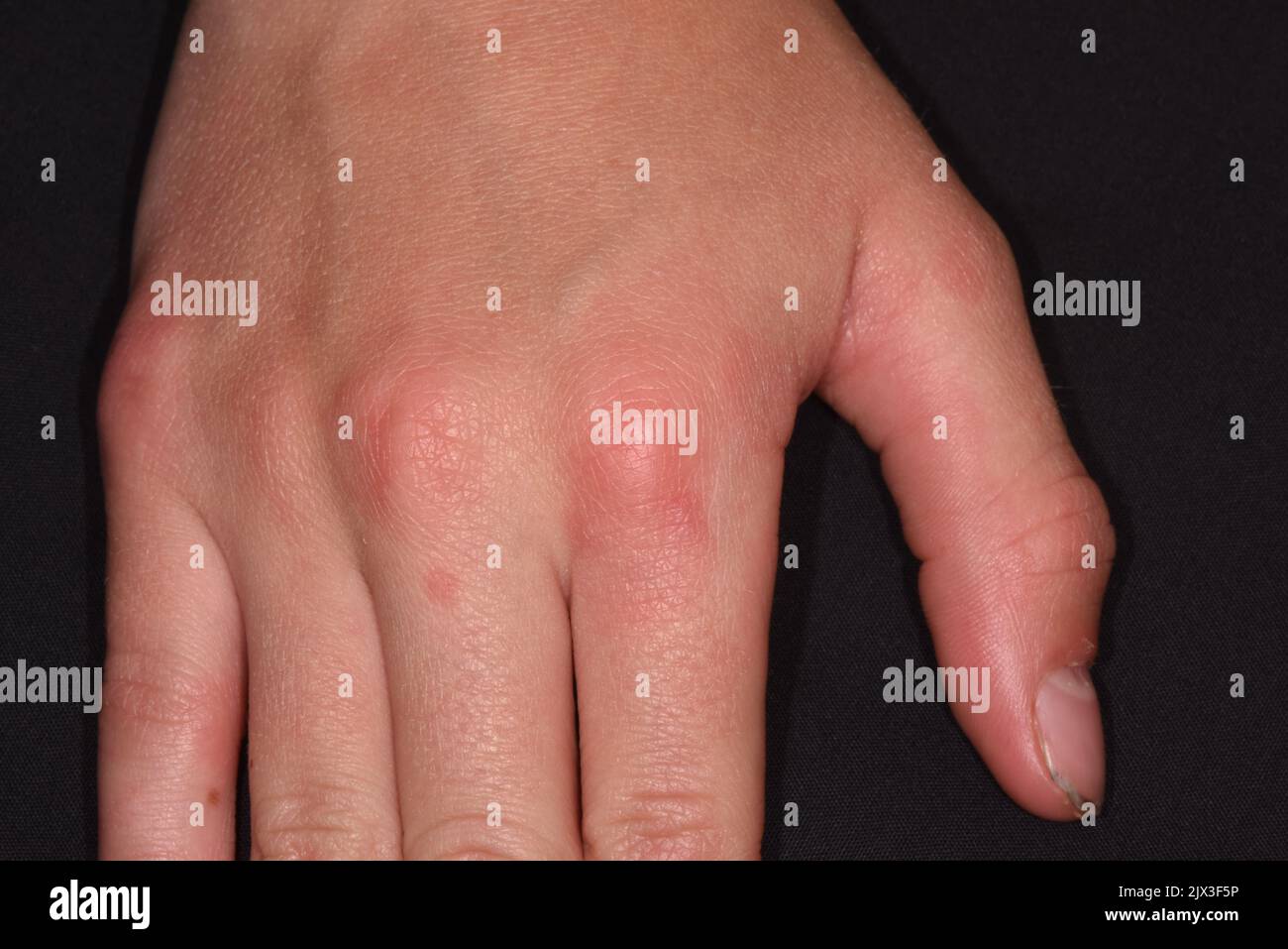 Close-up of hand, foot and mouth disease (HFMD) lesions on the hand of ...