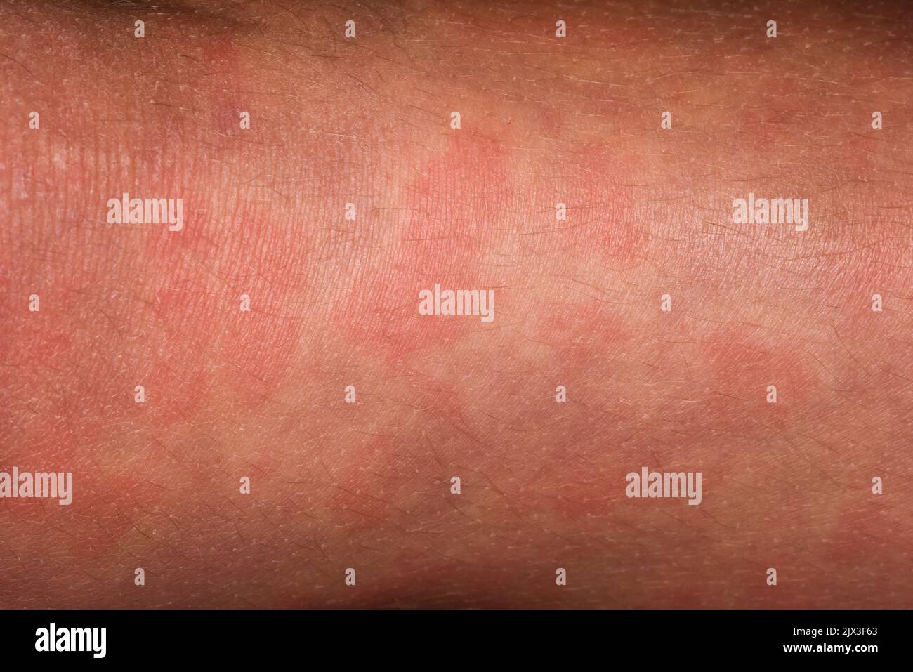 Urticaria, also known as hives or nettle rash, on the body of an 11 ...
