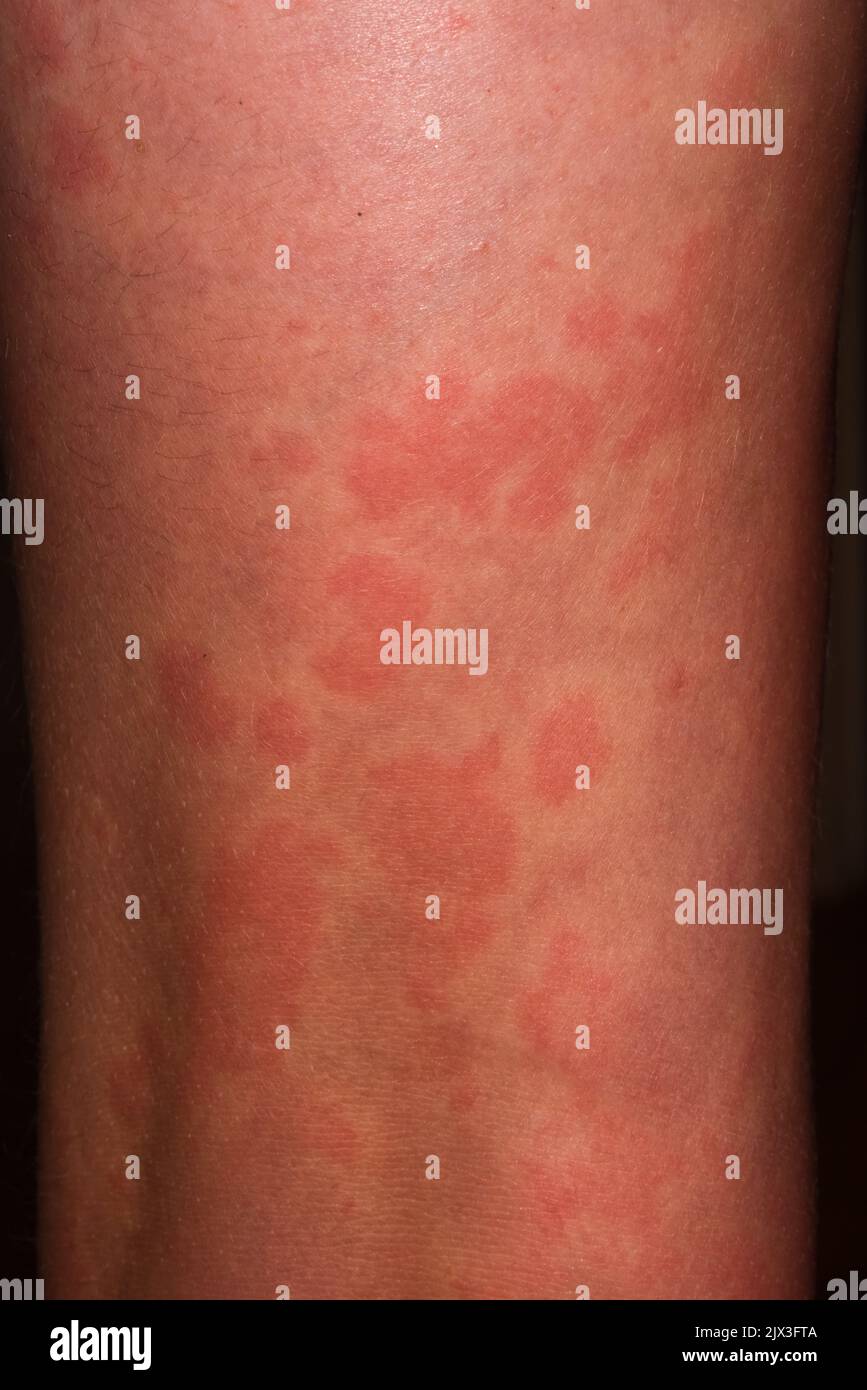 Urticaria, also known as hives or nettle rash, on the body of an 11 ...