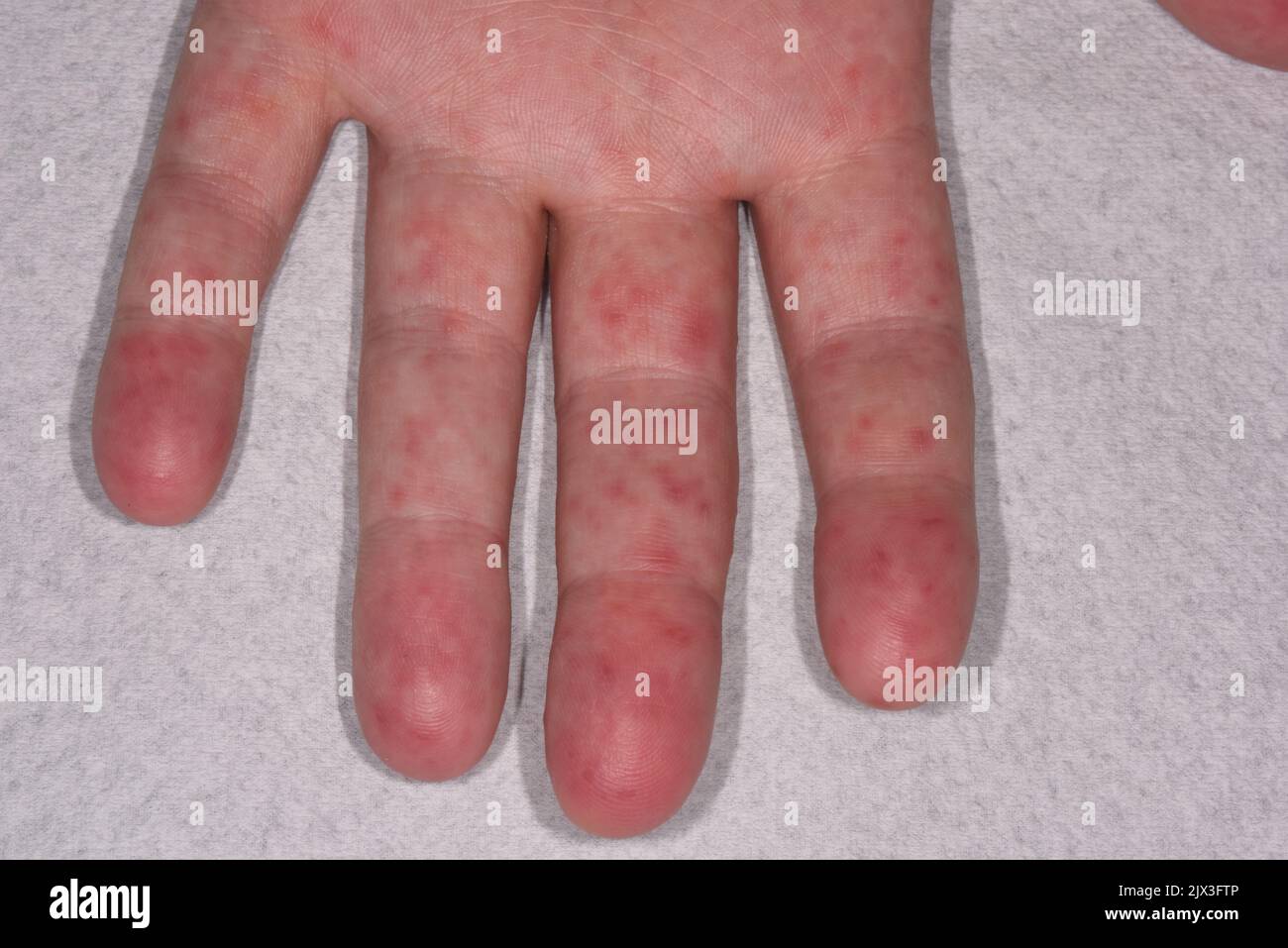 Hand, foot and mouth disease (HFMD) lesions on the hand of a 32-year ...